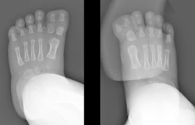 Congenital Hand and Arm Differences: Great Toe Polydactyly (extra toes)
