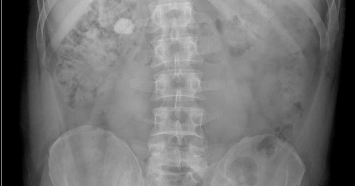 Residentes De Familia En Lanzarote Paciente Con Hematuria