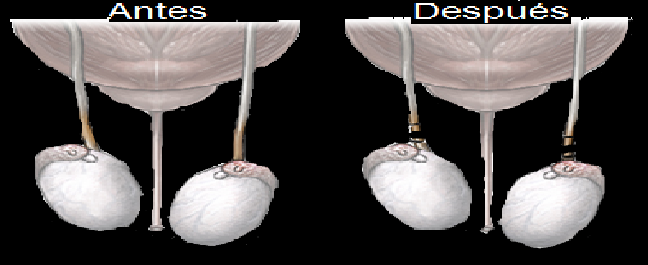 CONSTANZA - IBY ROJAS - ECA Estudio y Centro de Aprendizaje: VASECTOMÍA