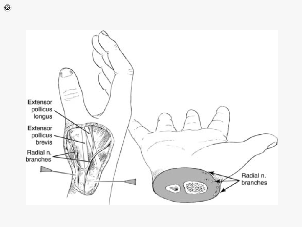 SRNA Daily Review: REGIONAL ANESTHESIA: BLOCKS