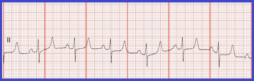 Practice EKG Rhythm Strips 143: Various Hyperkalemia