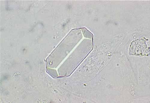 Atlas of Crystals found in alkaline urine | Free Medical Atlas
