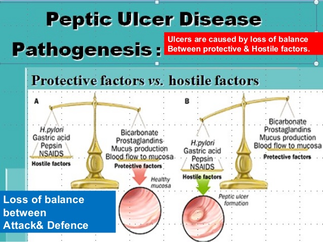Peptic Ulcer