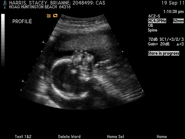 .: 2nd Trimester Ultrasound