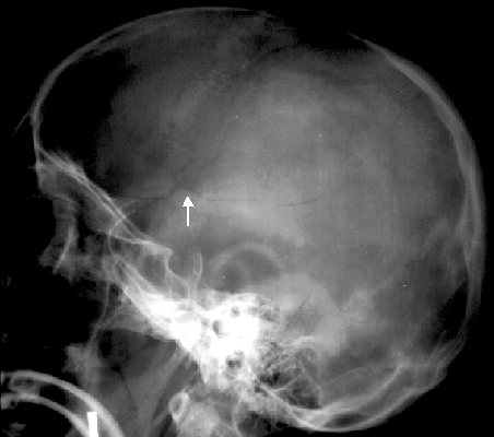 Anatomía 2012 - Ayudante Pablo Prado: Pterion: Correlato Clínico