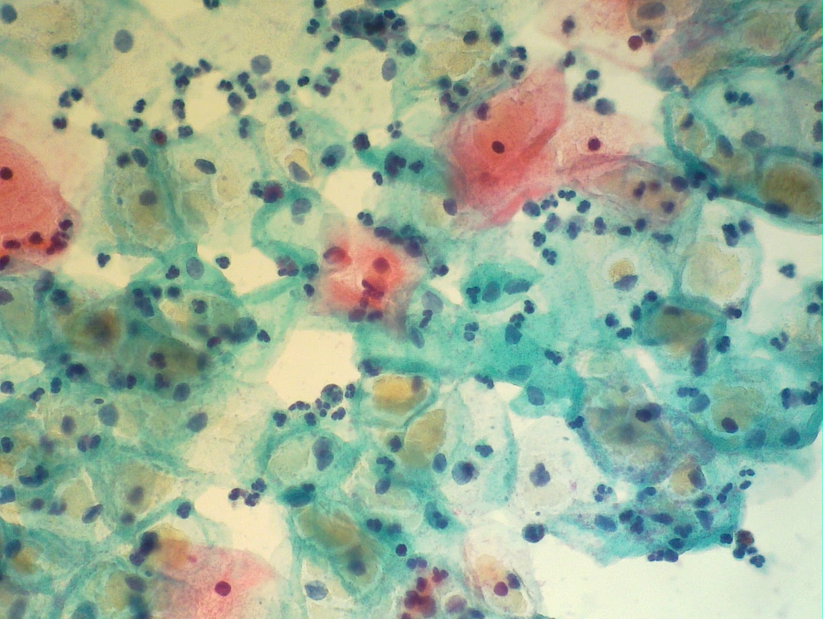 The Cell Hunter Society: Case No. PAP4777-11 Glycogenated