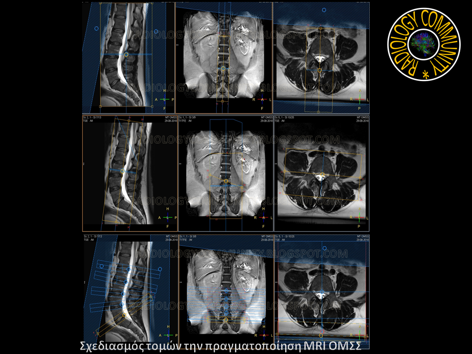 Radiology Community: Μαγνητική Τομογραφία Οσφυϊκής Μοίρας Σπονδυλικής ...