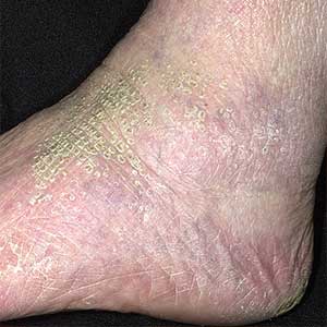 Healthy Living: Foot Care In Diabetes