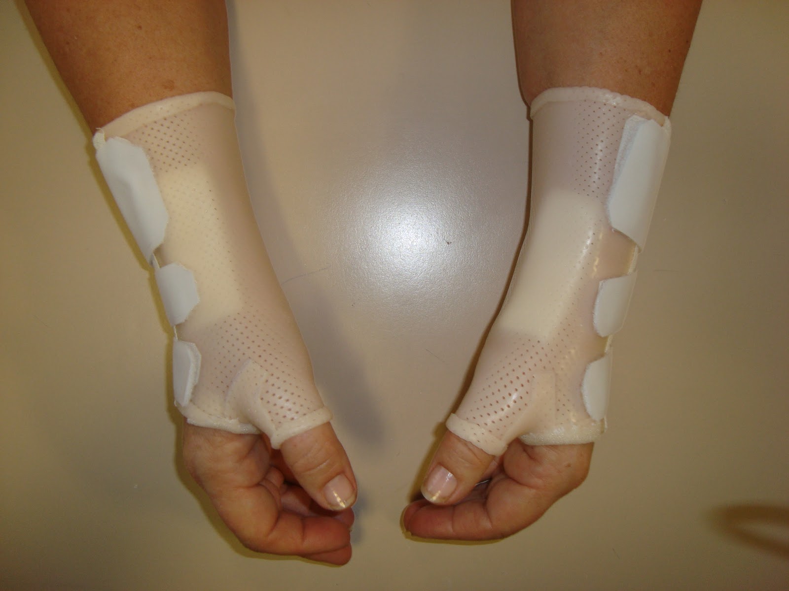 Orthèses sur mesure et appareillage personnalisé main poignet doigts ...