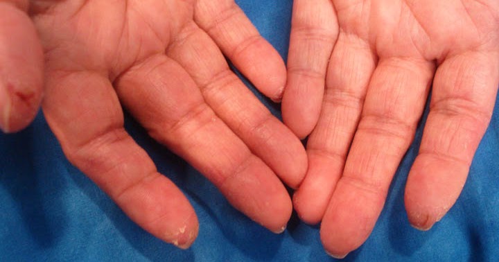 VIRTUAL GRAND ROUNDS IN DERMATOLOGY 2.0: Painful Finger Tips Secondary ...