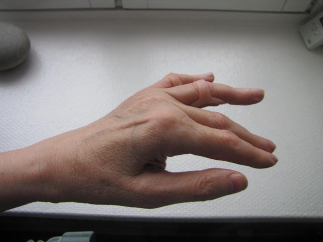 Handrehabilitationcase with Dupuytren's contracture.: A trauma in the ...