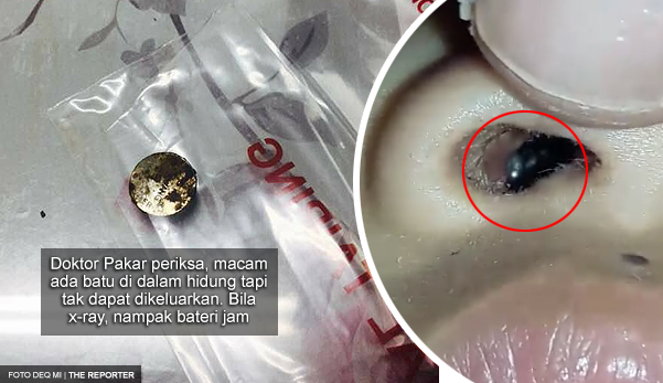 Terkejut tengok bateri jam dalam hidung anak | The Reporter