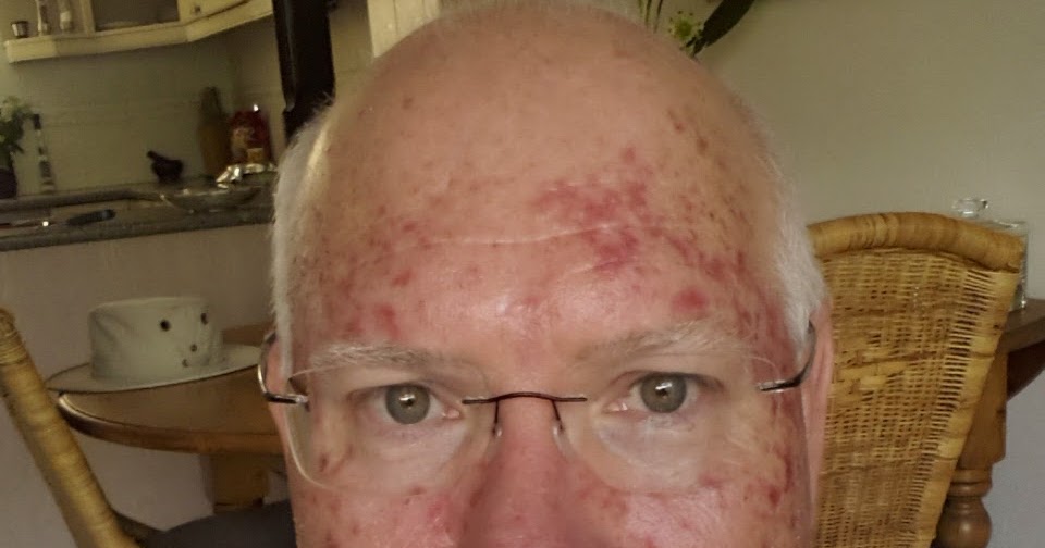 Resultaat gebruik Efudix: Dag 07