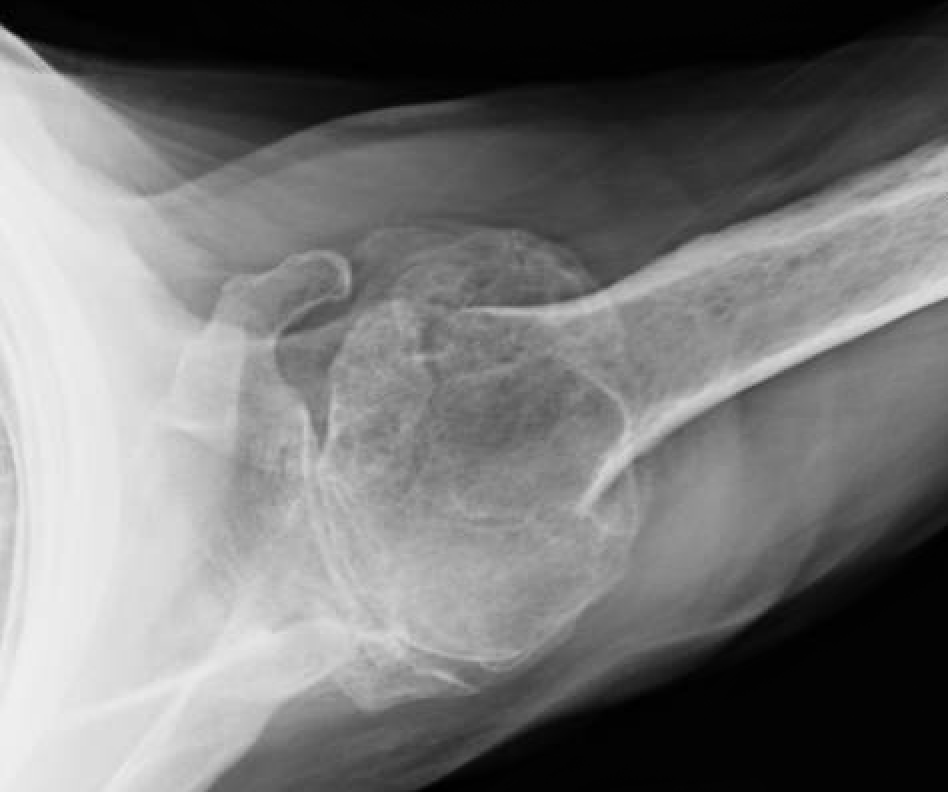 Shoulder and Elbow Surgery: Dislocation of reverse shoulder replacement ...