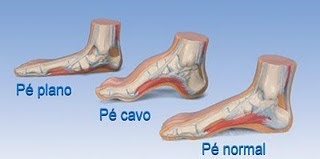 Fisioterapia Quintana: QUAL A DIFERENÇA ENTRE PÉ CHATO E PÉ CAVO?