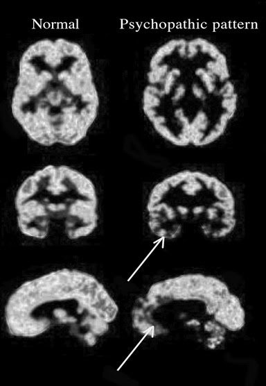 More Brain Points: Do we have different brains than killers?