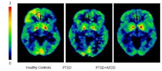 Snapshot of the pieces: Brain Scan & Hope