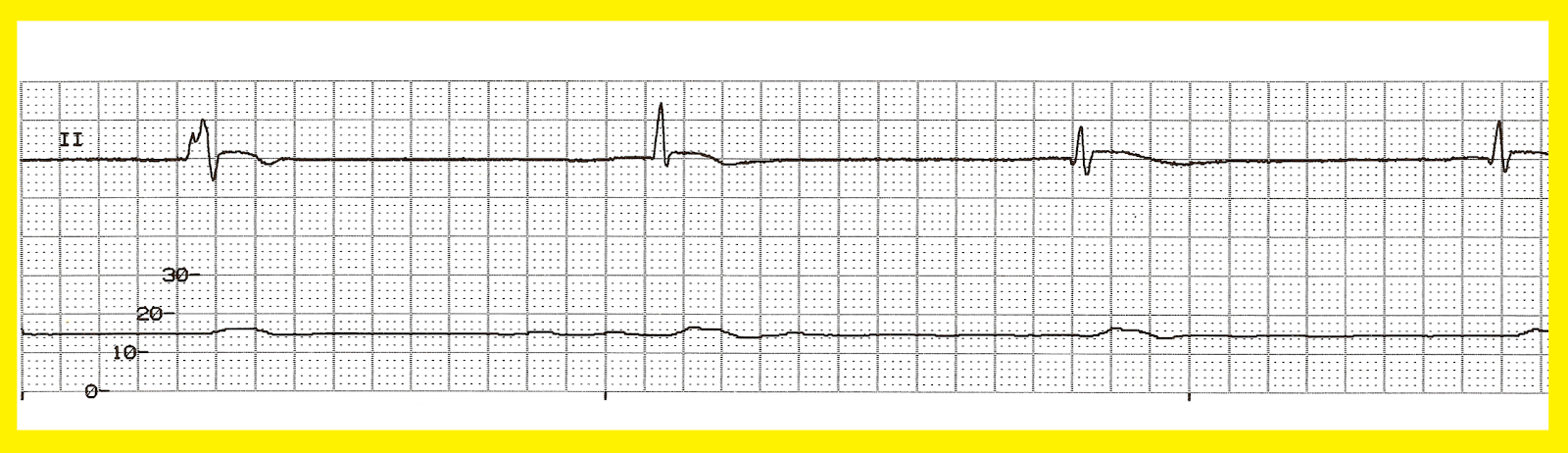 Practice EKG Strips 335