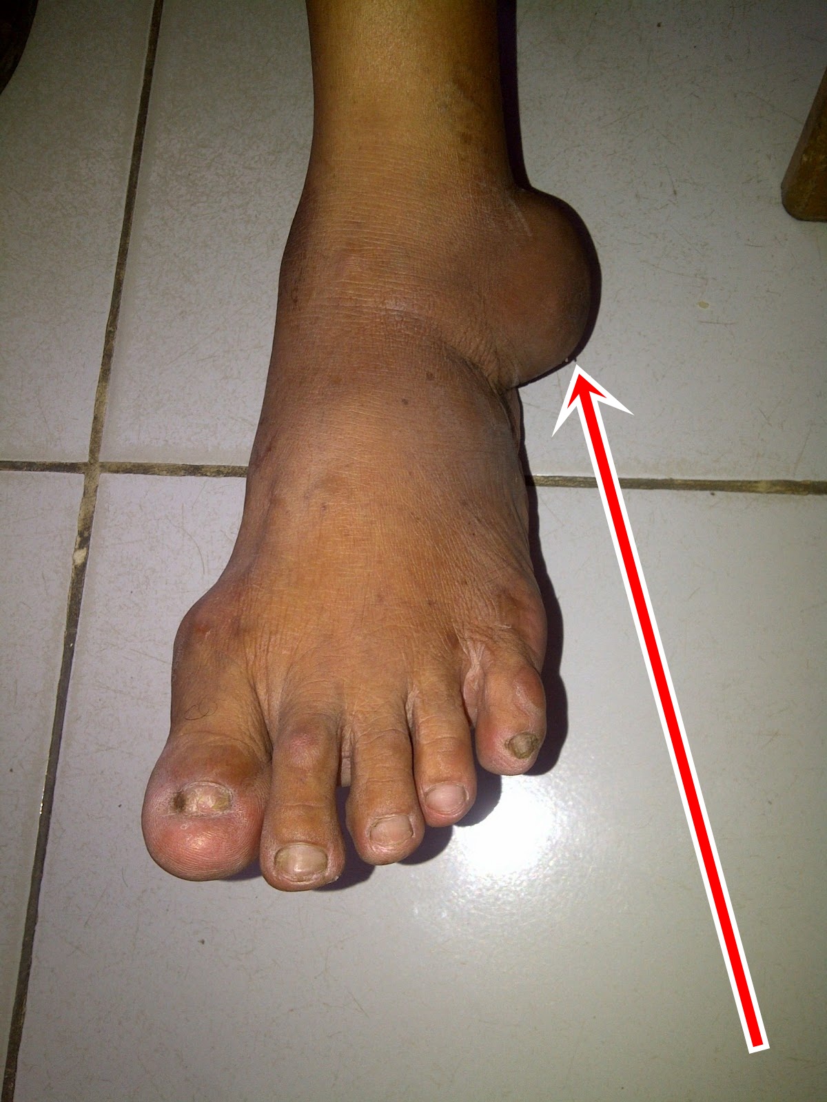 Obat Benjolan Di Mata Kaki Yang Manjur ~ Puput Agen Suplemen Herbal