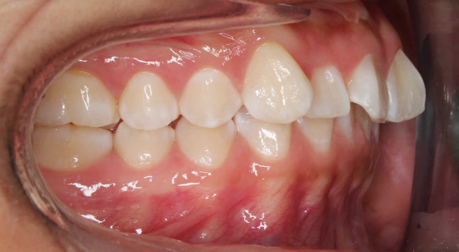 Br@ndy's Invisalign Journey: June 2011