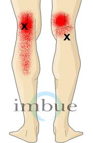 Pain Behind Knee: Pain Behind Knee - Symptoms