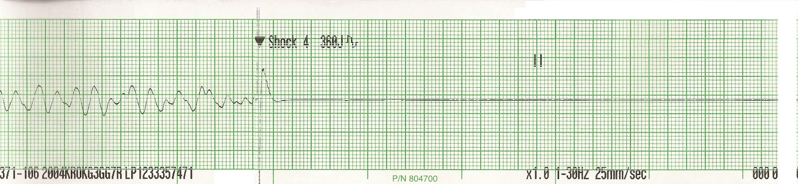 Float Nurse: Pulseless VF/VT