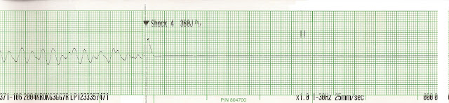 Float Nurse: Pulseless VF/VT