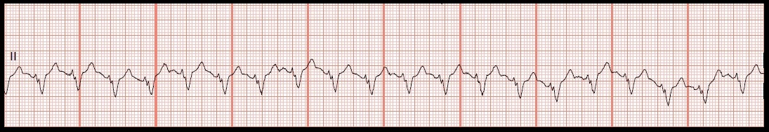 Practice EKG Rhythm Strips 160