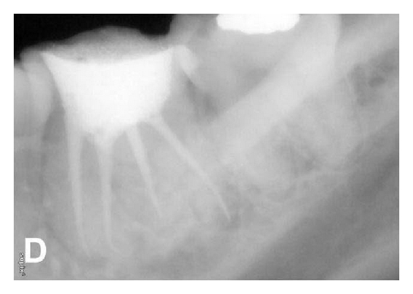 SUHASIS ONLINE: Four-Rooted Mandibular First Molar with an Unusual ...