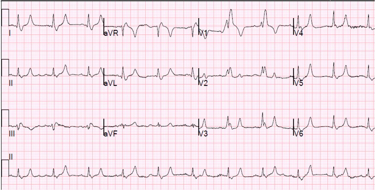 Dr. Smith's ECG Blog: Is This a Simple Right Bundle Branch Block?