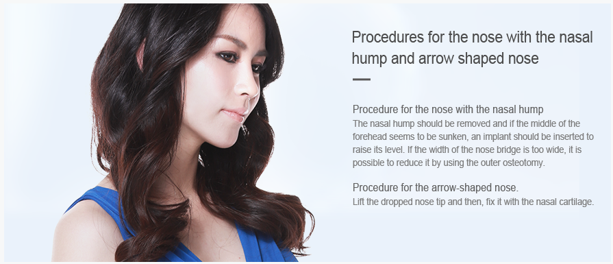 [Nose:Rhinoplasty] Long Nose Correction