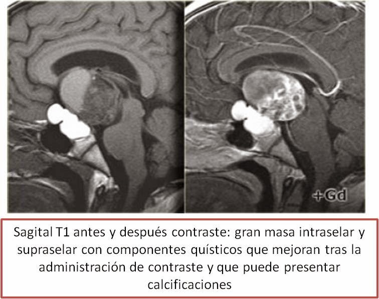 ESPE 203-2013: Patología de región selar: rol de imagenología