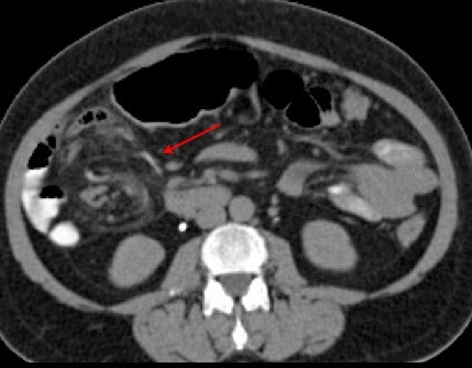 BLOG SCAN: HERNIA INTERNA