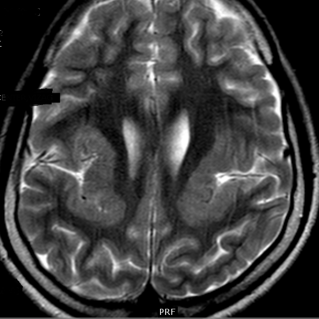 Polymicrogyria-Teaching Points - Sumer's Radiology Blog
