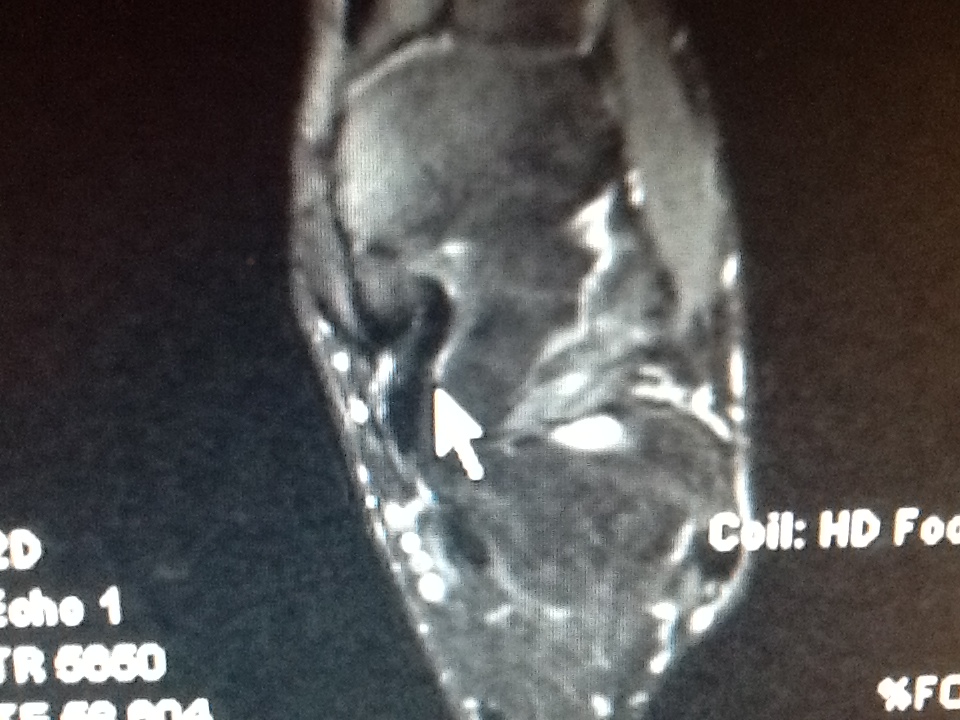 Foot and Ankle Problems By Dr. Richard Blake: Images for Os Navicularis ...