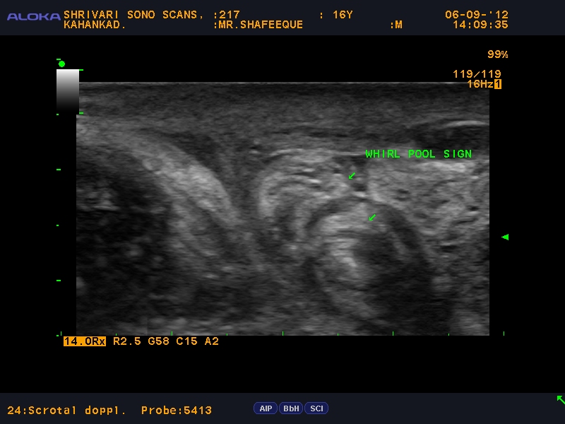 Shrivari Sono Scans: Ultrasound images in acute scrotum--Torsion Testis