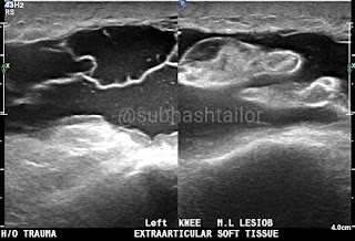SONO DIGEST: MOREL LAVALLEE LESION ON ULTRASOUND