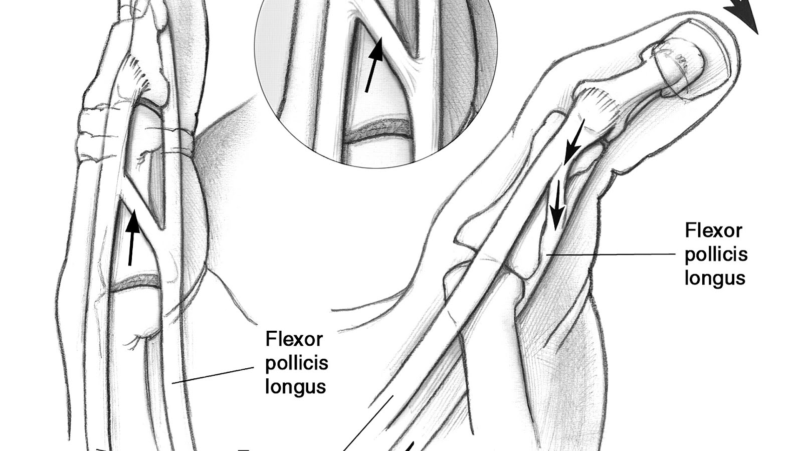 Flexor pollicis longus muscle Injury - Injury Choices