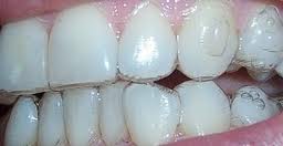 RiteBite Orthodontics: What are Invisalign Attachments?