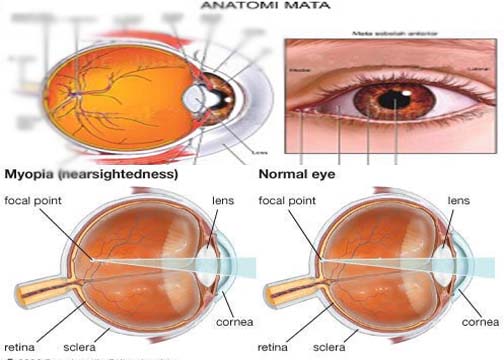 PENGOBATAN PENYAKIT MATA DENGAN VARASH NATURAL OIL - Minyak Varash ...