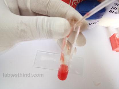Sickle Cell क्या है | Sickling Test कैसे करते है – ( Slide Method ...