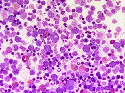 fichero hematologia: Policitemia Vera