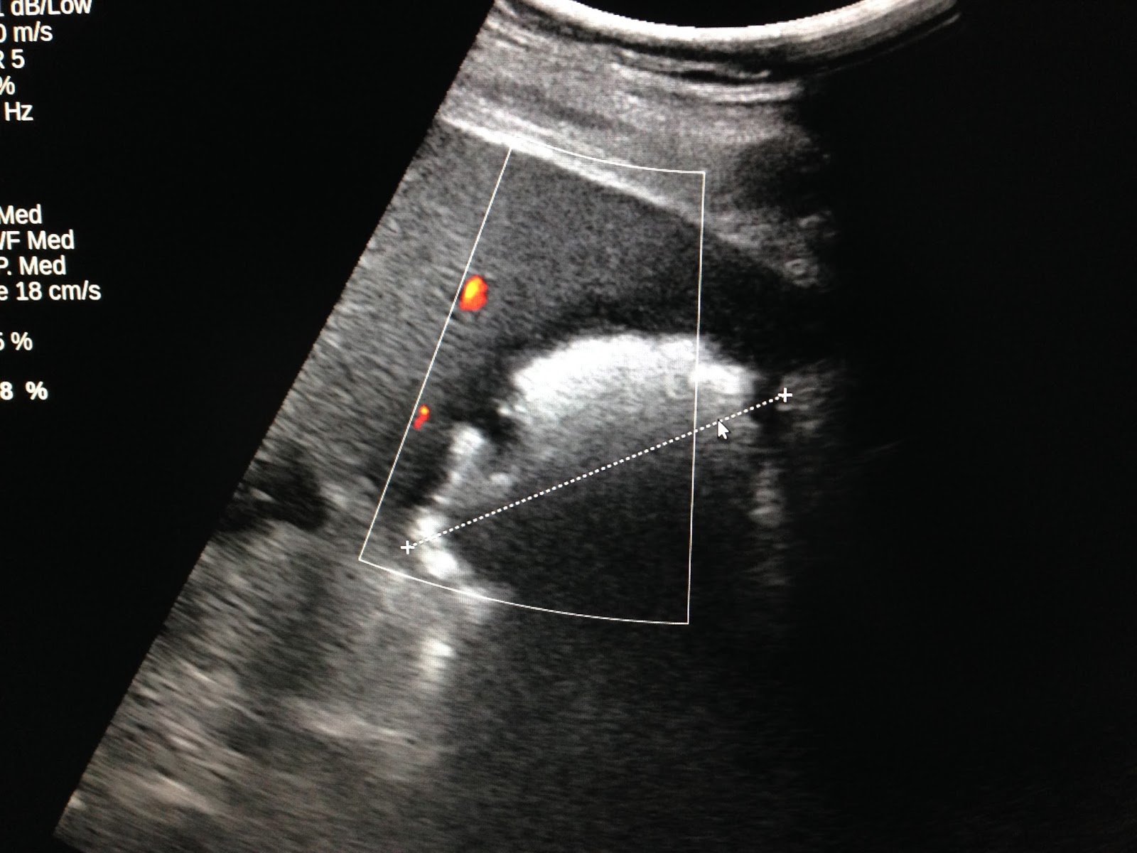 VIETNAMESE MEDIC ULTRASOUND: CASE 462: LIVER ABSCESS POST ENDOSCOPIC ...