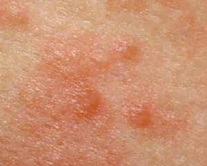 7 Penyebab Gatal Pada Kulit, beserta Tanda-Tandanya