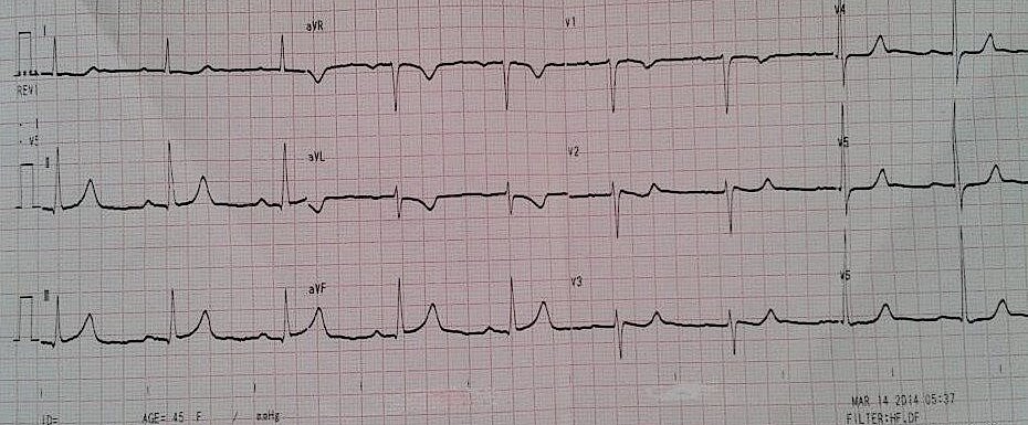 Dr. Laxman Dubey : Significance of lead aVL