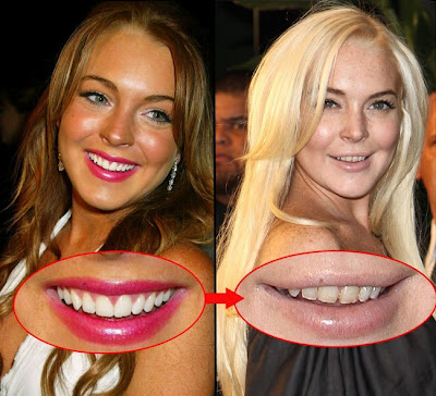 Signs Of Cocaine Use Teeth