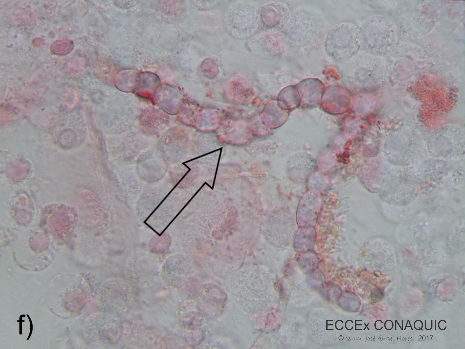 Caso UR-julio-17 (Enfoque: bacteriuria)