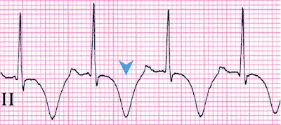 Study Medical Photos: Cerebral 'T waves' on ECG