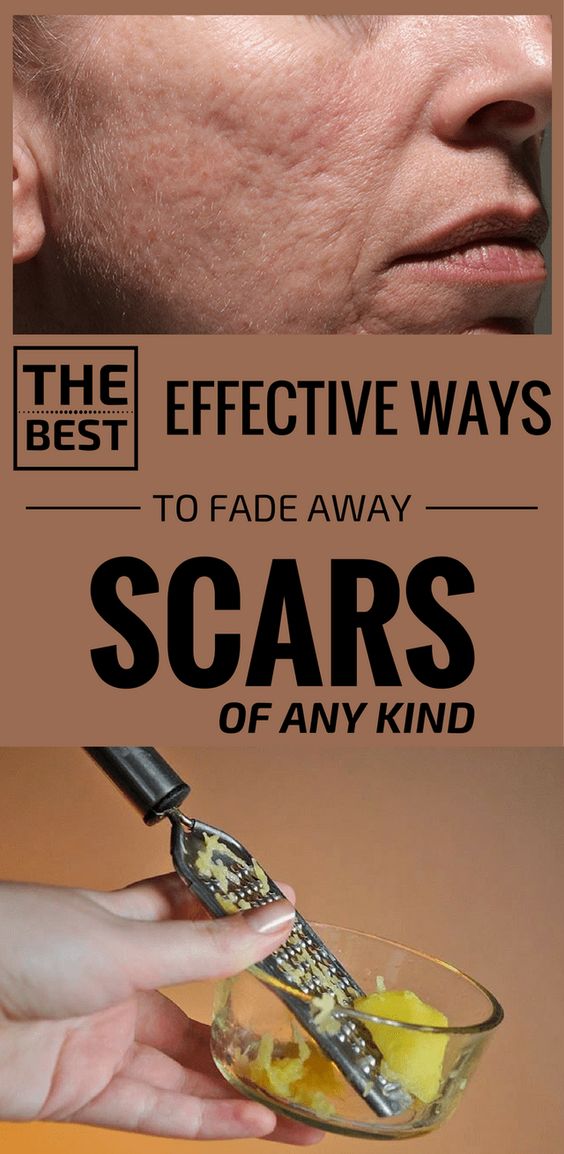 The Best Effective Ways To Fade Away Scars Of Any Kind HEALTH CAPSULES the-best-effective-ways-to-fade-away-scars-of-any-kind-health-capsules
