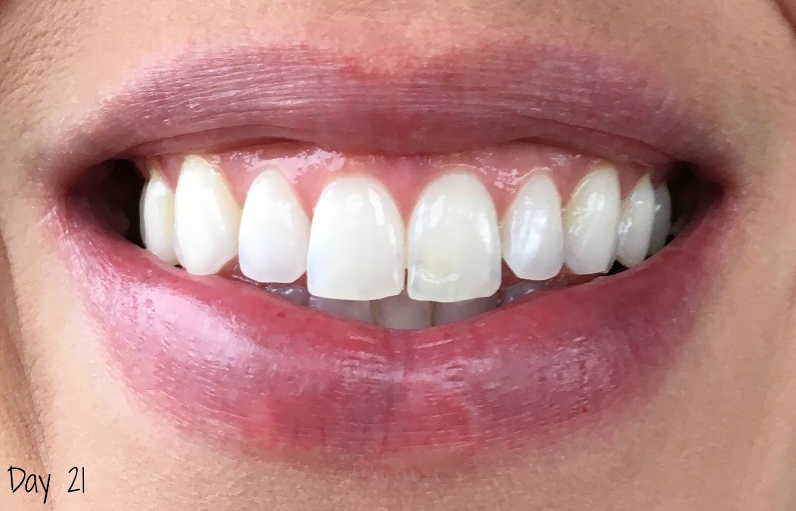 Sparkles and Lattes: At Home Teeth Whitening with Smile Brilliant